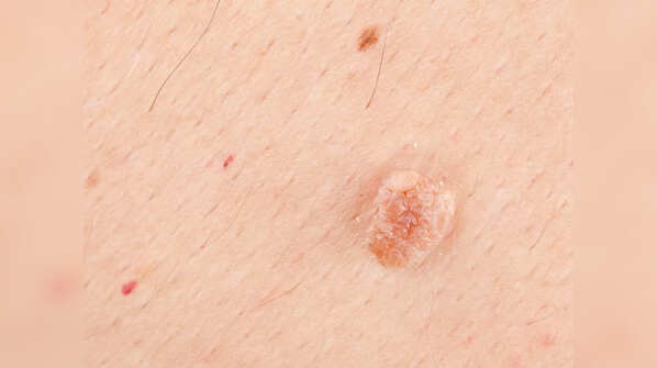 STIs that can cause warts and lumps on skin