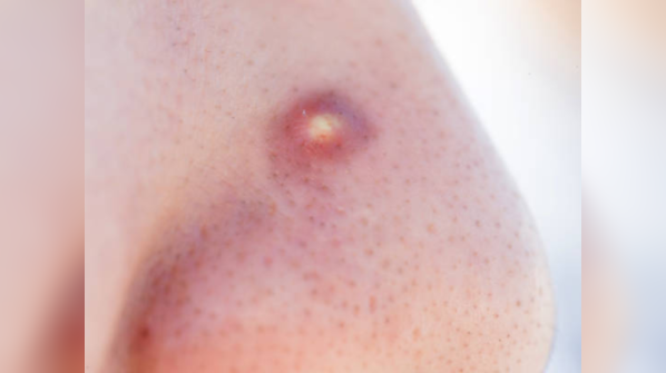 Skin Cancer Symptoms: Woman's 'hard pimple' that she covered with ...
