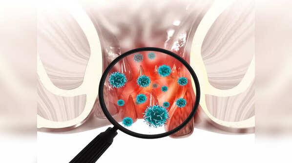 Cancer symptoms: Warning signs of anal cancer that can appear on the toilet