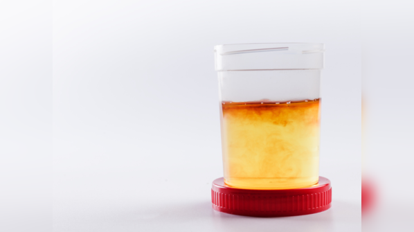 Warning sign in your pee that could signal bladder cancer