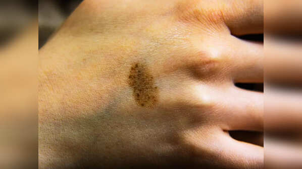 Revealed! What your birthmark conveys about your personality