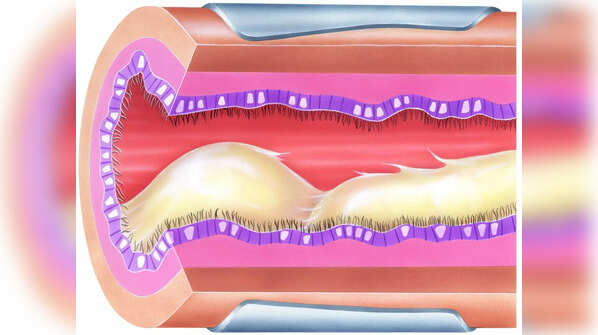 Coronavirus explainer: Lingering cough after COVID-19? Why it happens ...