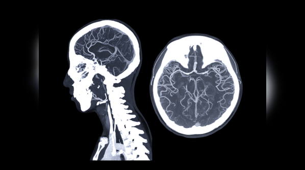 What are the warning signs of a Brain Aneurysm