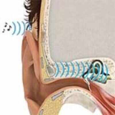 New implant replaces impaired middle ear