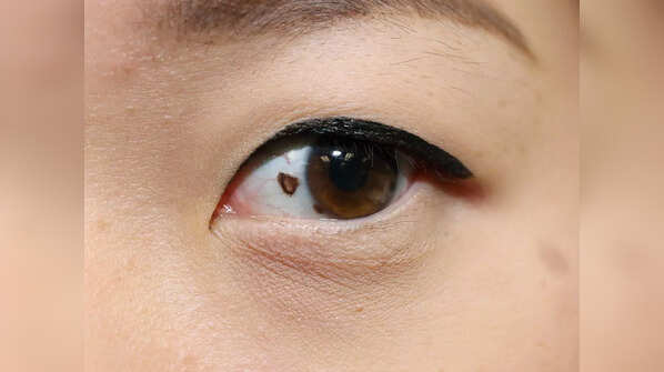 Moles on Body Parts: What moles on different body parts reveal about ...