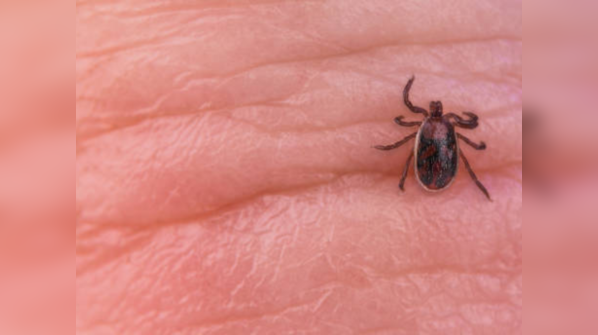 Typhus: Texas man loses hands and feet from a SINGLE flea bite; almost ...