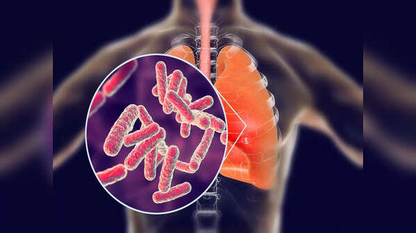 WHO report: Tuberculosis deaths and disease increase during the COVID ...