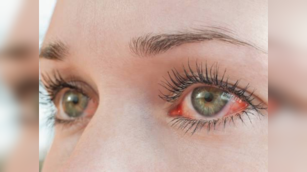 Conjunctivitis Eye Infection Symptoms: Conjunctivitis cases surge in Delhi, 100 cases in AIIMS ...