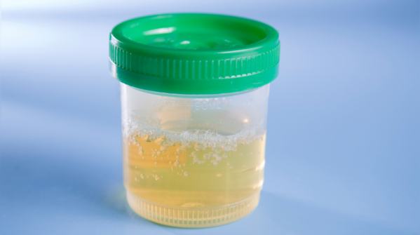 Kidney Damage Symptoms: From foamy urine to fatigue: 6 signs of kidney ...