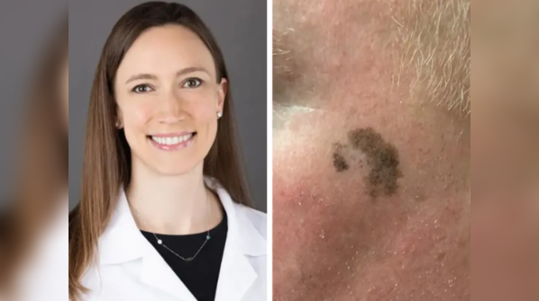Skin cancer: Dermatologist approached a man on a train for the dark ...