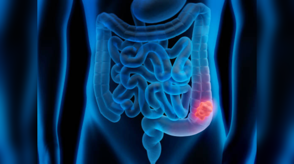 Colon cancer: Frequent burping led to diagnosis of cancer in 24 year ...