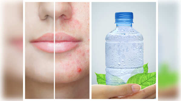 Drink water to get rid of those pimples!