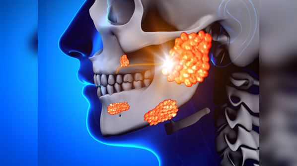 Mumps Symptoms: All about the symptoms and prevention tips for the ...