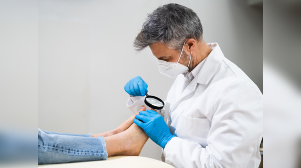 Coronavirus: Experts say these 4 signs of COVID are found on the skin