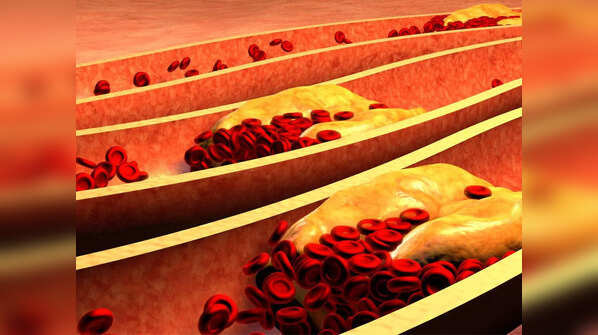 High cholesterol Symptoms: The smelly warning sign of high cholesterol ...