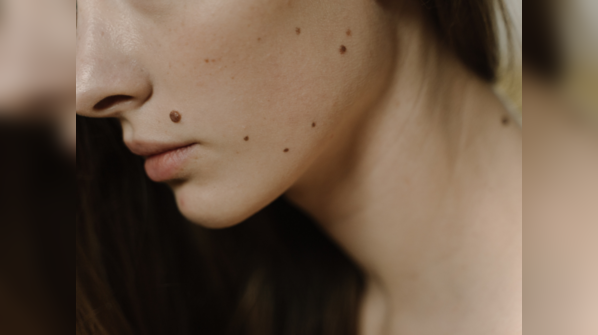 If you have moles on these parts of your body, here's what it means ...
