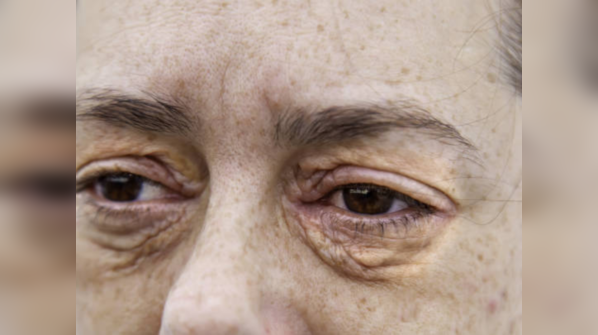 Cholesterol symptoms: 3 Warning signs of high cholesterol in your eyes