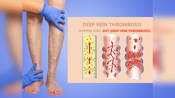 Deep vein thrombosis: 18-year-old thought she had pulled a muscle ...