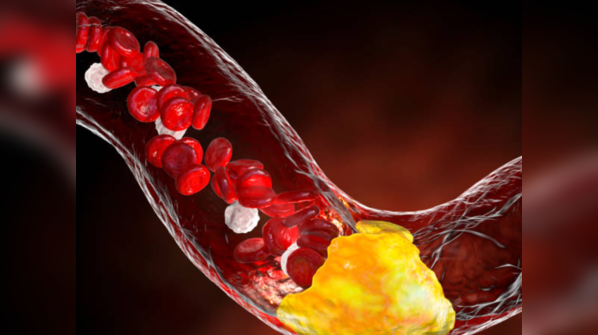What is the right age to start monitoring blood cholesterol?