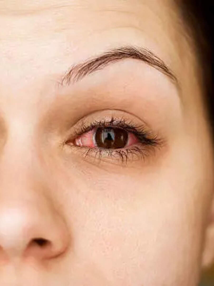Beware! 4 Menacing Signs Of High Cholesterol In Your Eyes That You ...