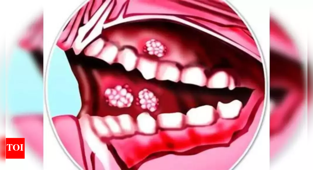 Oral Cancer 26% In Ngp, Surpasses Natl Average Of 10%: Data | Nagpur ...