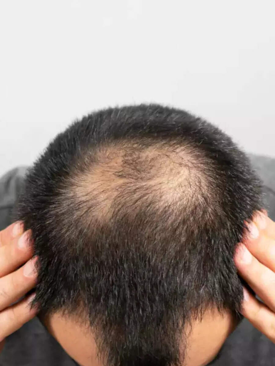 Hair Care Tips: Sure shot natural remedies to reverse balding | Times ...
