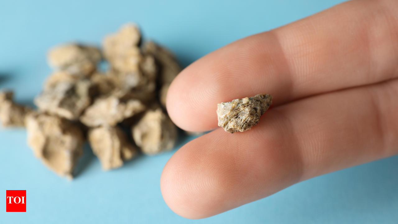 Is This The Worlds Largest Kidney Stone Hands Of Hope Medical