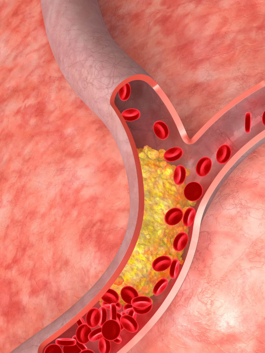 Pain in these 8 areas indicate high cholesterol | Times of India