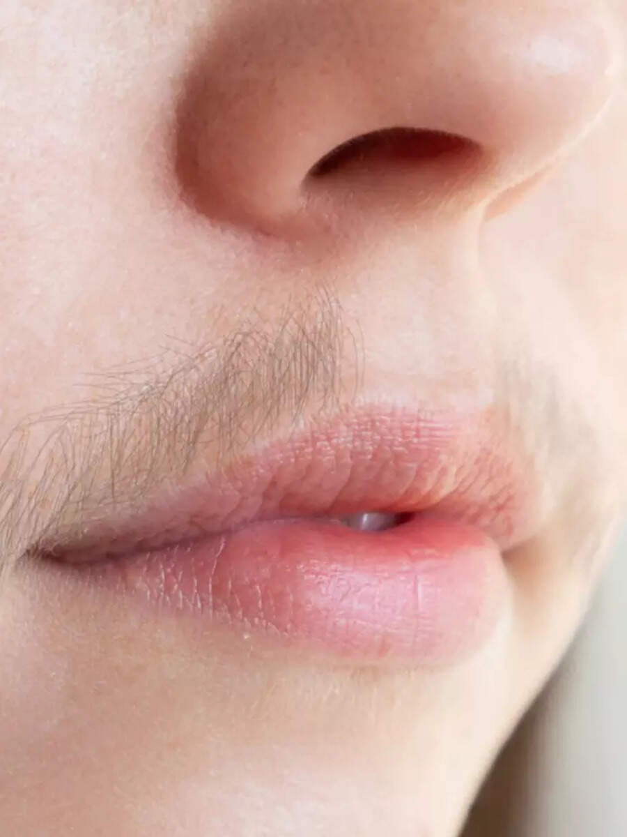 10 home remedies to deal with hirsutism or excessive hair growth ...