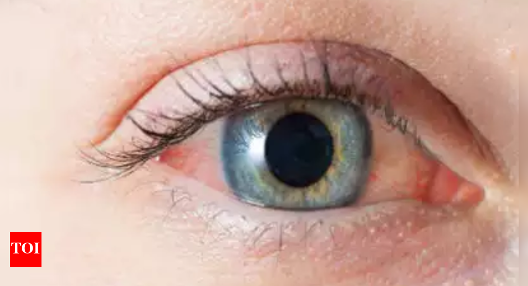 65 kids affected as 'pink eye' spreads to PCMC areas | Pune News ...