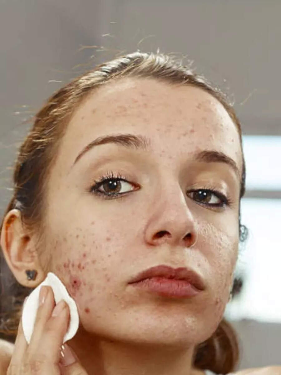 8 Foods That Damage Your Skin | Times Now