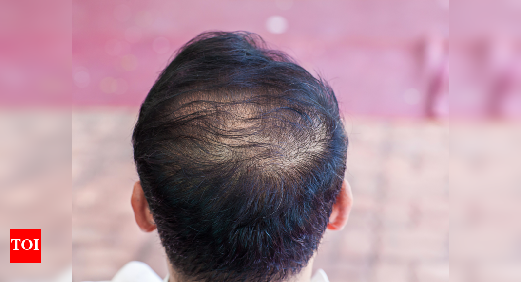 Does aloe vera reverse balding? - Times of India