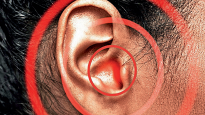 Surgery relief for 53-year-old Dutch patient who heard whooshing sound ...