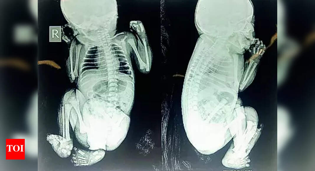 Civil Hospital: Rare Congenital Defect Corrected At Civil | Ahmedabad ...