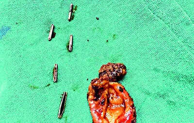 Surgery: Docs Left 5 Clips In Gallbladder 5 Yrs Ago, Removed | Jaipur ...