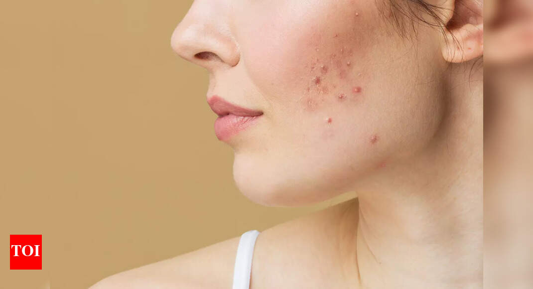 Understanding Acne: Myths, Facts, and Treatment Options - Times of India