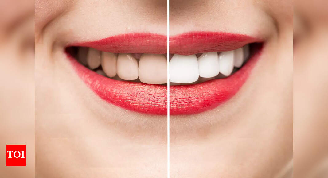 Teeth Whitening: The truth about teeth whitening: Myths and facts ...