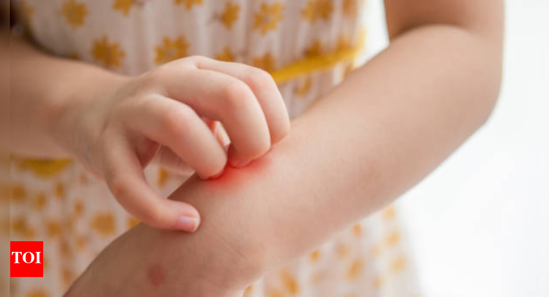 Hives in children: Causes and care tips - Times of India