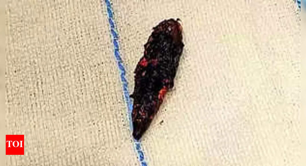 Bangalore Hospital news: Bengaluru doctors remove bullet stuck in man's ...