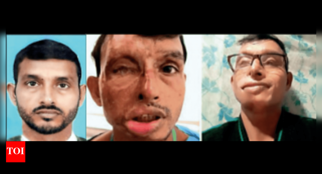 Acid Attack Victims: Acid Attack Victims Are Gender-Neutral: Calcutta ...