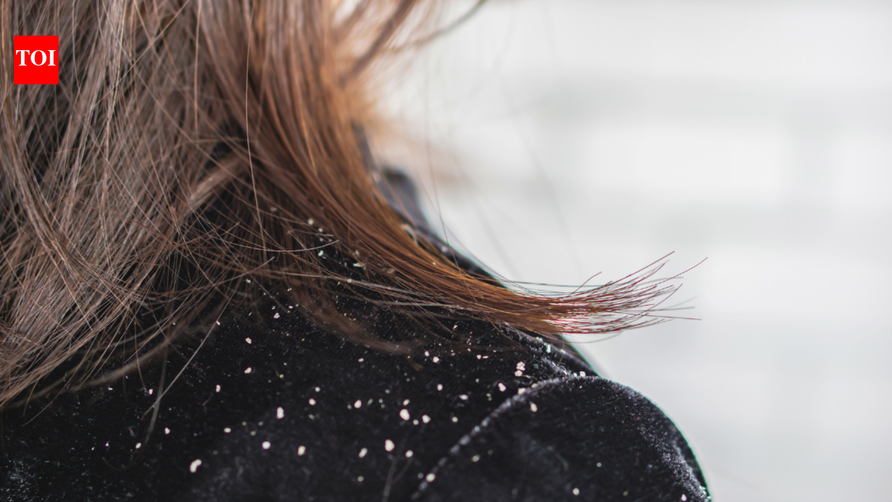 5 Simple But Effective Ways To Get Rid of Winter Dandruff | - The Times ...