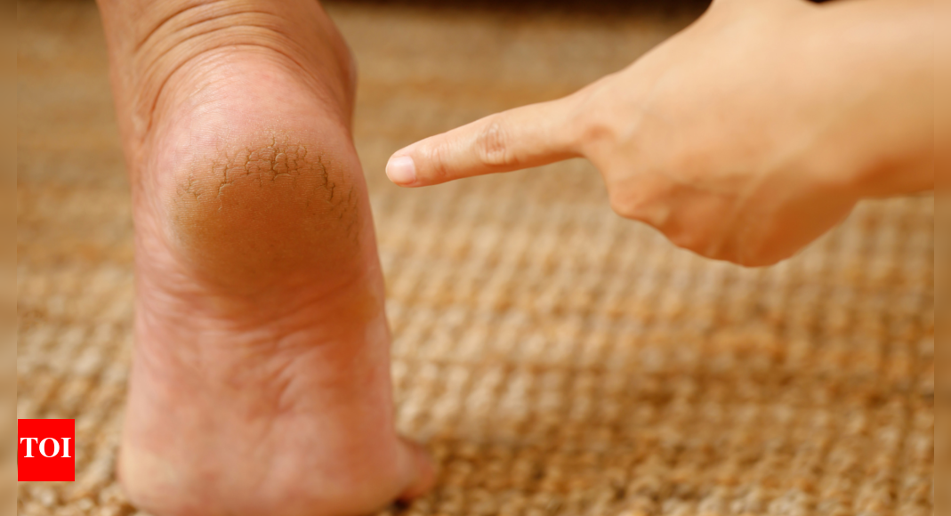 Home Remedies For Cracked Heels: Get Rid of Cracked Heels With These ... Home Remedies For Cracked Heels: Get Rid of Cracked Heels With These ...