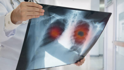 Pneumonia complications and the risks of late diagnosis - Times of India