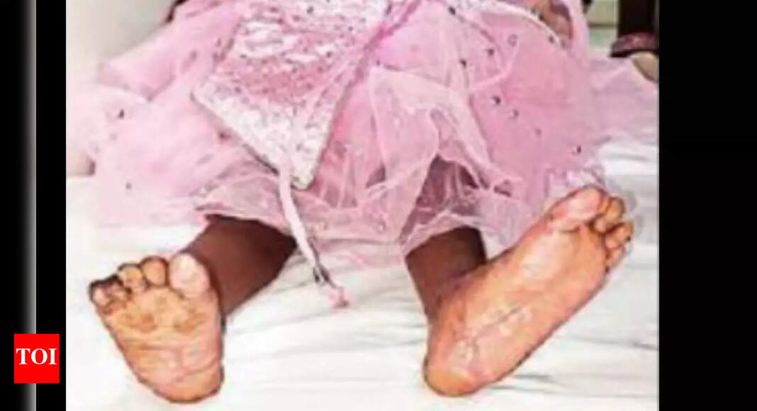 Legs Reattached: Three-year-old’s legs reattached - Ahmedabad News ...