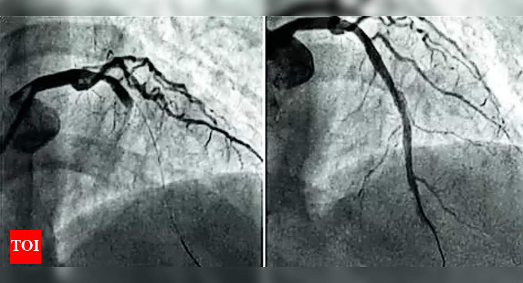 Angioplasty: Complex Angioplasty Saves Woman Vadodara: First Coronary ...