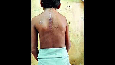 Bone Malformation: Successful Surgery Enables 12-Year-Old Girl with ...