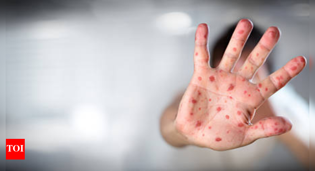 Chickenpox Symptoms and Prevention Tips: Over 6,000 chickenpox cases ...