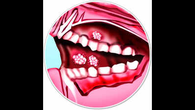 Oral Cancer: 291 Show Early Signs Of Oral Cancer In Check-up Camp At Jp ...