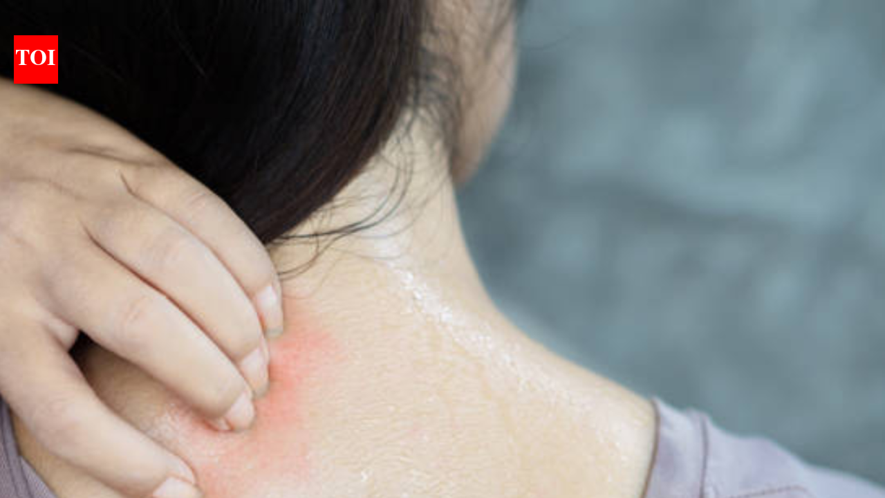 7 home remedies that can give relief from summer season itchiness