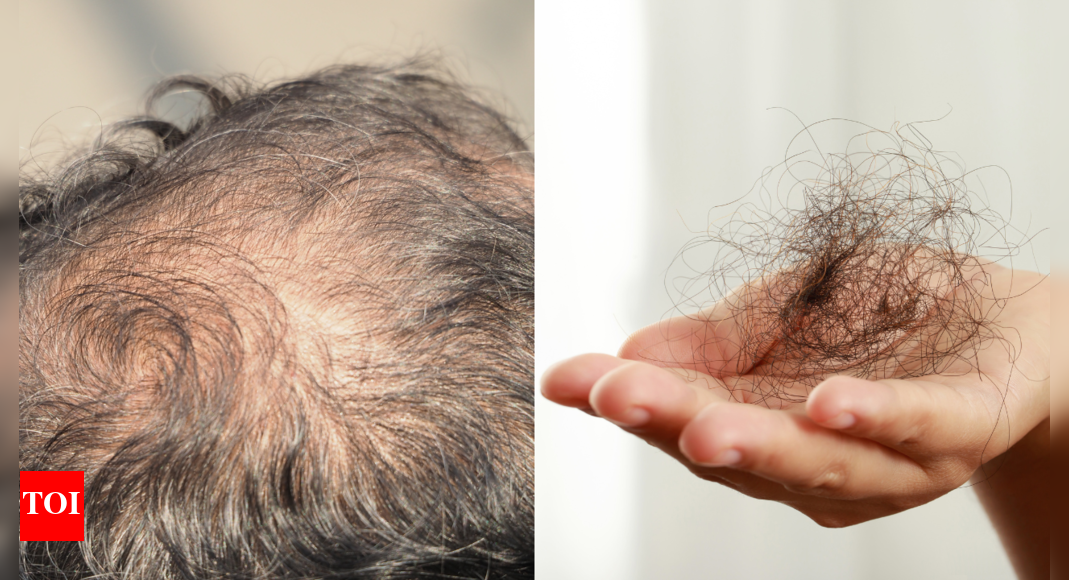 Hair Loss Reasons: 5 serious causes that may be causing hair fall ...